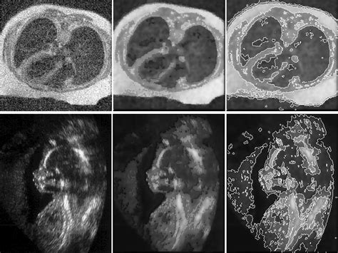 Segmentation And Smoothing Of Noisy Medical Images Left Column Top
