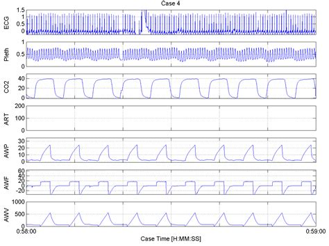 Case 4 Waveform Plots 60 Second Plots