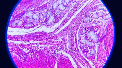 Scientists Reportedly Reversed Type 1 Diabetes By Reprogramming Patients Fat Cells Into Insulin