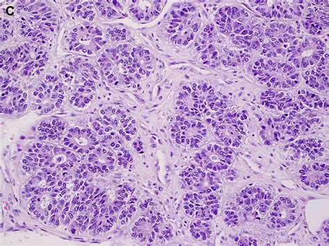 Cholangiocarcinoma Surgical Pathology Clinics