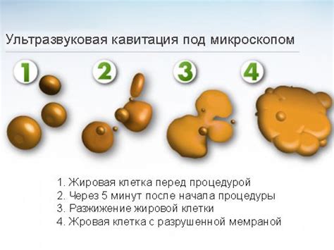 Ультразвуковая кавитация: противопоказания, последствия, побочные ...