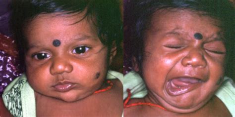 Depressor Anguli Oris Muscle