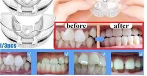 셀프 치아교정 속지 마세요거짓광고 등 무더기 적발