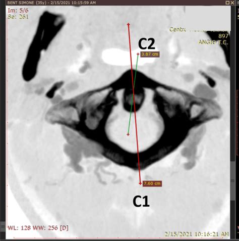 Jugular Vein Compression Due To The Neck And Cci Regenexx