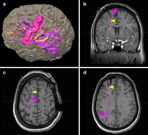 Fiber Tractography Of Lead 0 In Patient 3 Gpi Dbs Three Dimensional Download Scientific