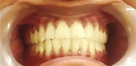 Completed Composite Build Up In The Anterior Teeth Download Scientific Diagram