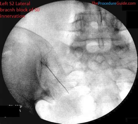Fluoroscopic Guided Sacroiliac Sij Joint Dorsal Ramus And Lateral