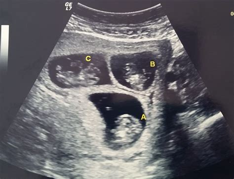 12 Week Ultrasound Triplets