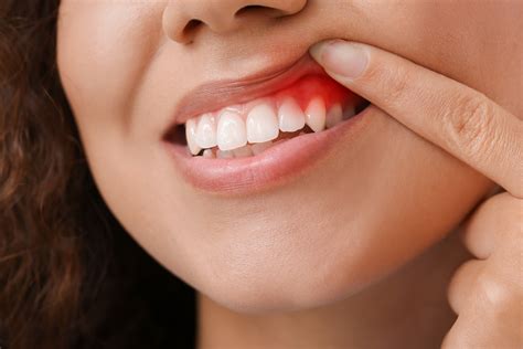 O Que é Gengivite Entenda As Causas Sintomas E Como Tratar Orthodontic