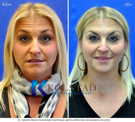 Best Botox In San Diego To Treat Forehead Wrinkles 8 Dr Kolstad