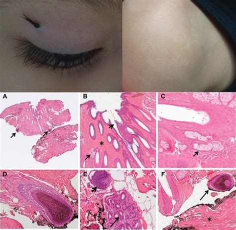 Full Article A 6 Year Old Girl With Ectopic Cilia And Hypochromic Nevus
