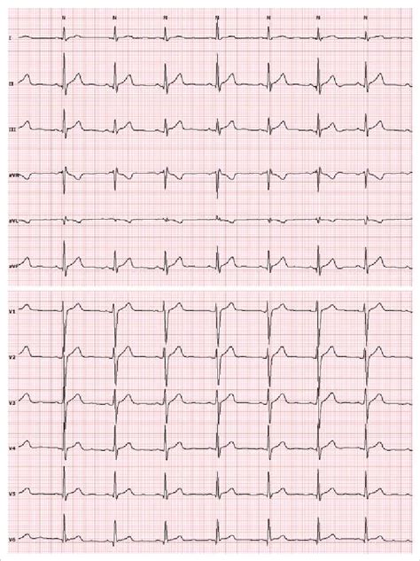 Electrocardiogram Recorded After Normalisation Of Hyperthyroidism Download Scientific Diagram