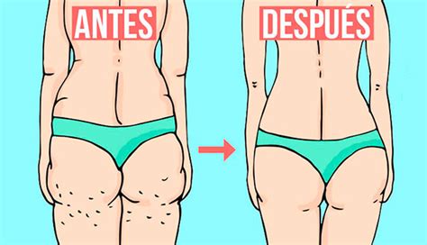 La Verdad Sobre Lo Que Realmente Causa La Celulitis Y Cómo Deshacerse