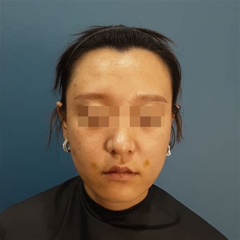 보톡스전후사진 다이브클리닉