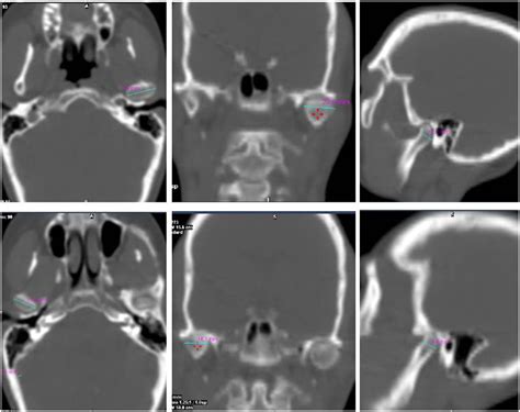 Bone Scintigraphy Spectct Evaluation Of Mandibular Condylar