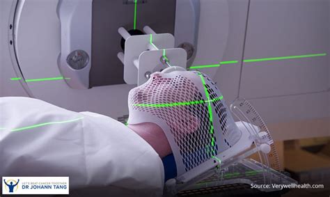 Stereotactic Radiosurgery And Radiotherapy Dr Johann Tang