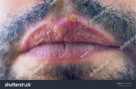 Bacterial Infection On Lips