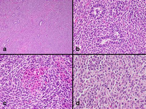 Histopathological Findings Of The Mesenteric Tumor A Low Power View B Download Scientific