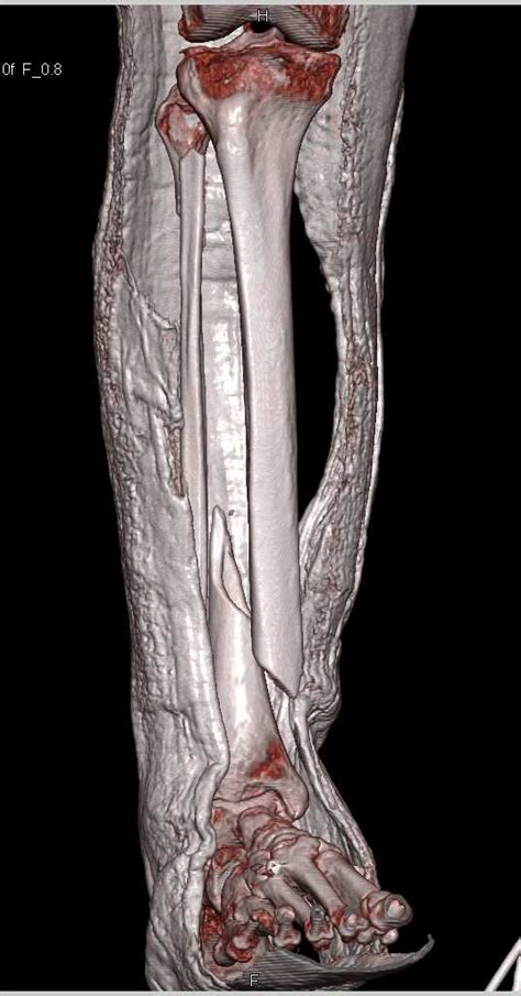 Open Fracture Tibia Musculoskeletal Radiology Case Studies Ctisus