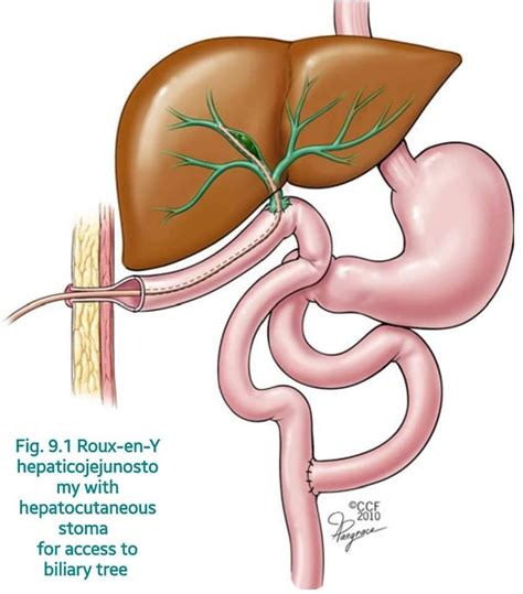 Hepaticocutaneous Jejunostomy •the Use Of Intestinal Stomas In