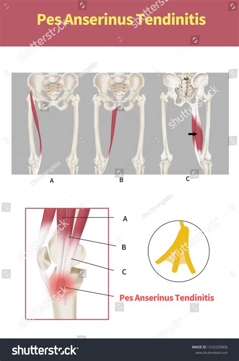 Medical Illustration Explain Pes Anserinus Tendinitis Stock Illustration 1529205806