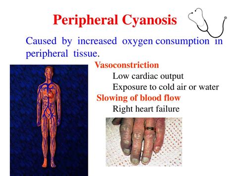 Ppt Cyanosis Powerpoint Presentation Free Download Id1341572