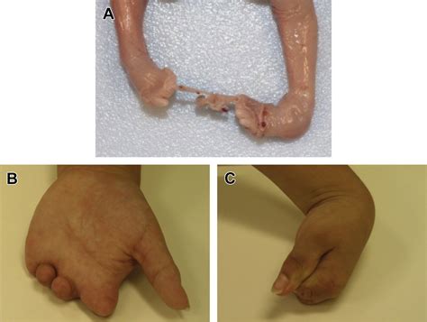 Congenital Limb Deficiency