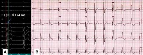 12 Lead Ecg Tracings A Baseline B Post Crt D Qrs D Qrs Duration