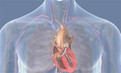 Impella Use During High Risk Pci Leads To Better Survival And Outcomes Compared To Iabp