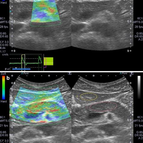Elastography Manufactured By Philips Elastography Manufactured By Download Scientific Diagram