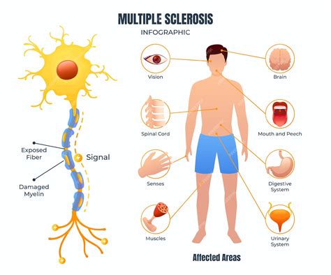 Premium Vector Hand Drawn Flat Design Multiple Sclerosis Infographic