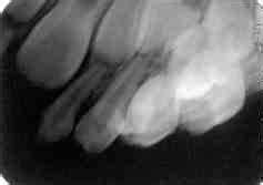 ORAL RADIOLOGY A Case Report The Compound Odontome Oral Health Group