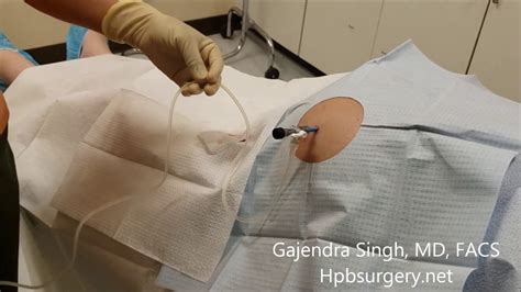 Removal Abdominal Fluid Or Ascites Paracentesis YouTube