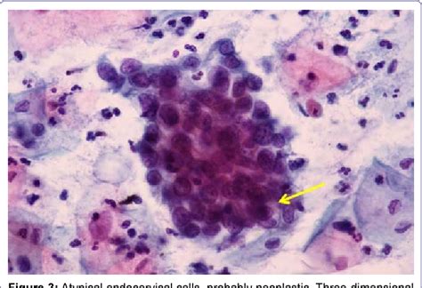 Figure 3 From Issues Of The Evaluation Of Endocervical Cells Of The Uterine Cervix On