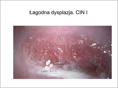 Sensacyjne Leczenie Lsil Hpv Cin 1 Zaktualizowano Wrzesień 2024