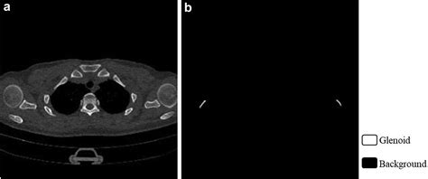 Glenoid Segmentation From Computed Tomography Scans Based On A 2 Stage