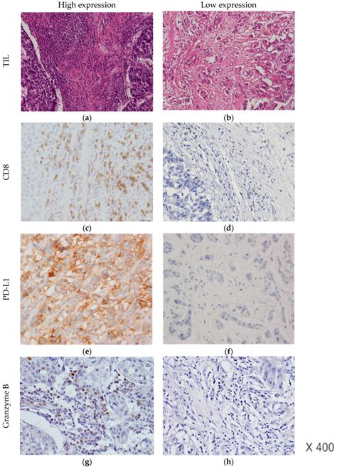 Immunohistochemistry For Til Cd8 Pd L1 And Gzmb In Triple Negative