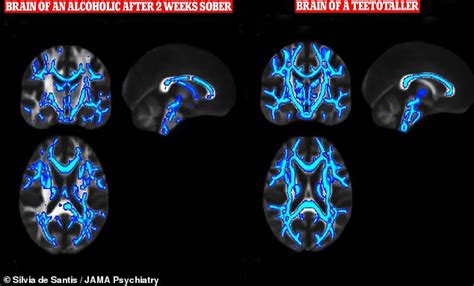 Alcohol And Depression Brain Scan