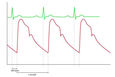 Normal Arterial Line Waveforms Deranged Physiology
