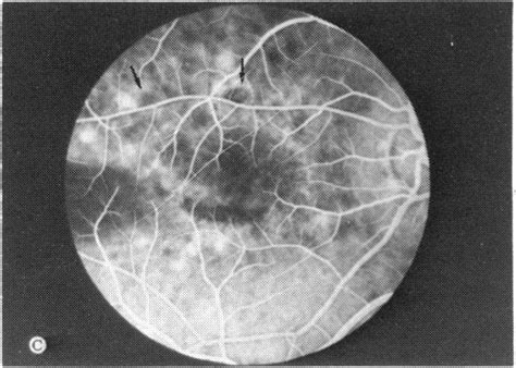 Case 2 October 5 1985 A Right Eye B Left Eye C Right Eye