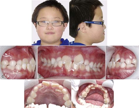 14 Treatment Strategies For Developing And Nondeveloping Class Iii Malocclusions Pocket Dentistry