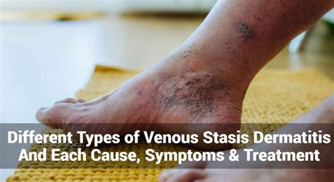 Different Types Of Venous Stasis Dermatitis And Each Cause Symptoms