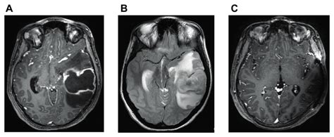 Axial Mri In A Patient With A Cortical Left Temporoparietal Abscess A