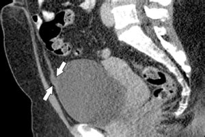 Imaging Of The Urachus Anomalies Complications And Mimics Revista