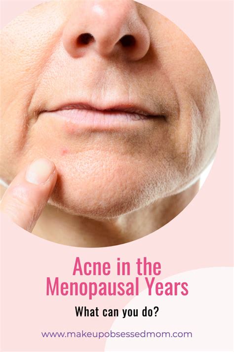 Acne In The Menopausal Years The Makeup Obsessed Mom Blog