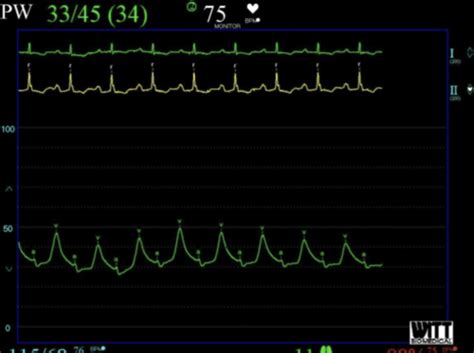 Lecture 12 Pressure Waveforms Review Flashcards Quizlet