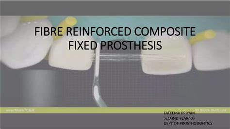 Fiber Reinforced Composite Fixed Prosthesis Ppt