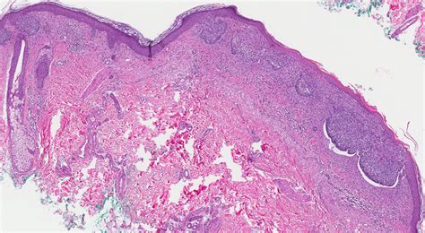Histologynodular Basal Cell Carcinoma Low Power