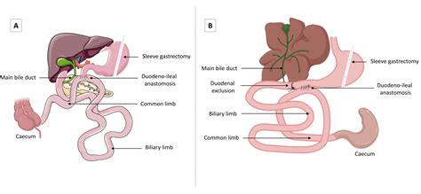 Single Anastomosis Duodeno Ileal Bypass With Sleeve Gastrectomy Model
