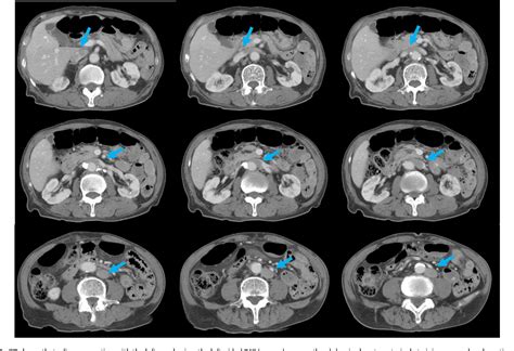 Figure 2 From Laparoscopic Sigmoidectomy For Sigmoid Colon Cancer With